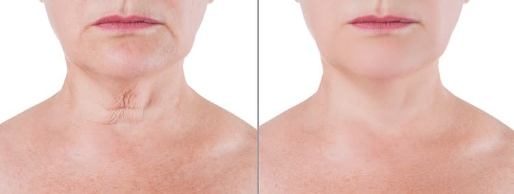 Does Facelift Surgery Correct Turkey Neck | Altos Oaks Plastic Surgery